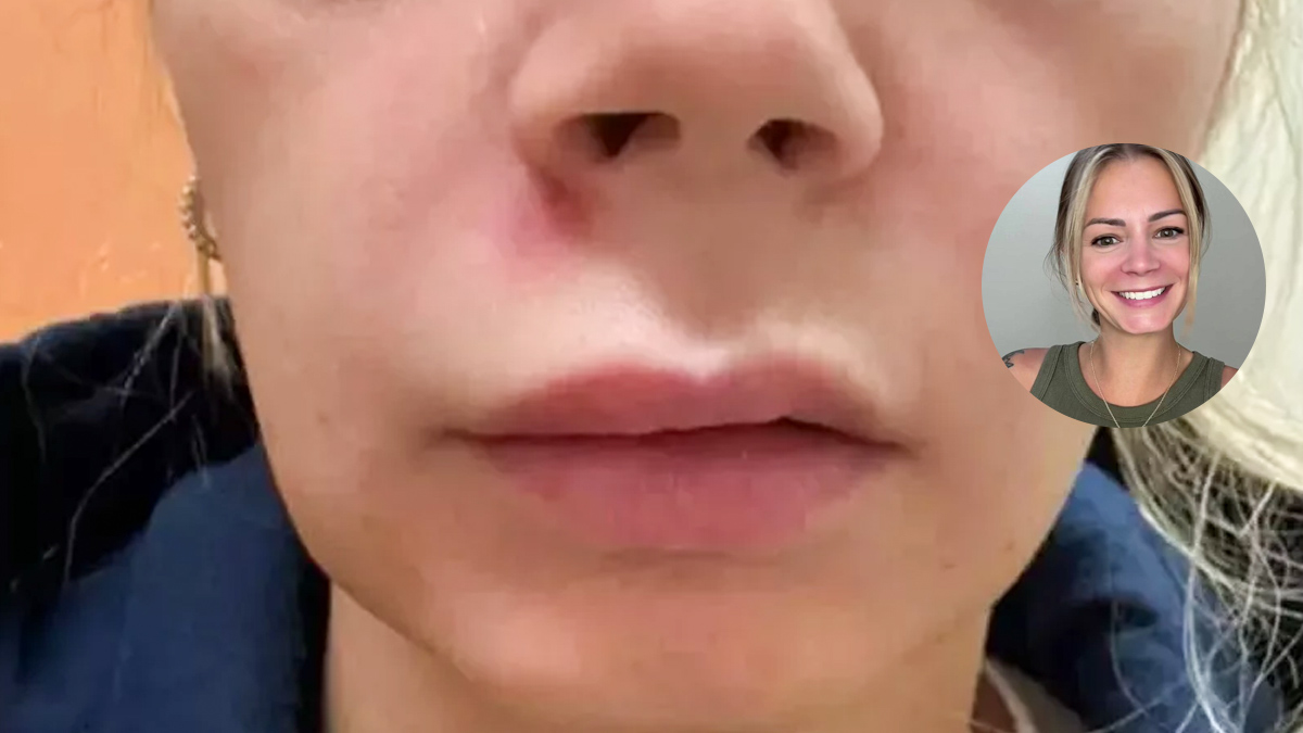 How Popping a Pimple Triggered Facial Paralysis: Exploring an Unusual ...