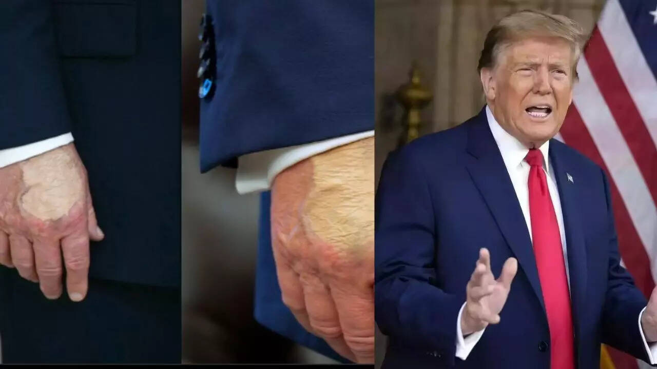 US President Donald Trump spotted with hand makeup again and swollen ...