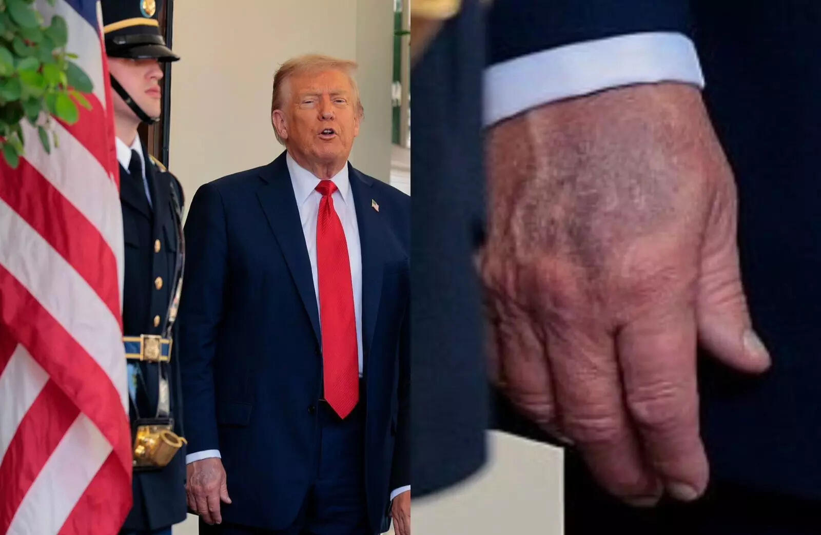 Trump’s bruised hand at Oval Office signing sparks serious concerns ...