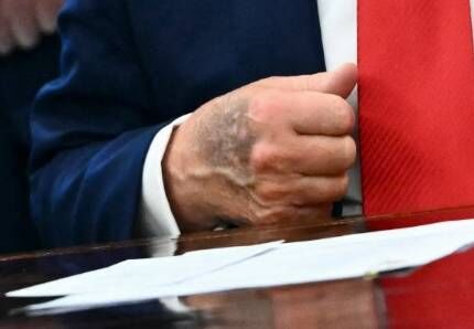 Donald Trump's badly bruised hand in Oval Office sparks concern