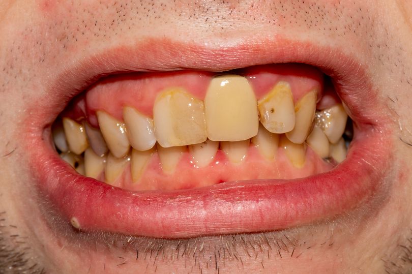 British Army rejects scores of applicants because they have bad teeth