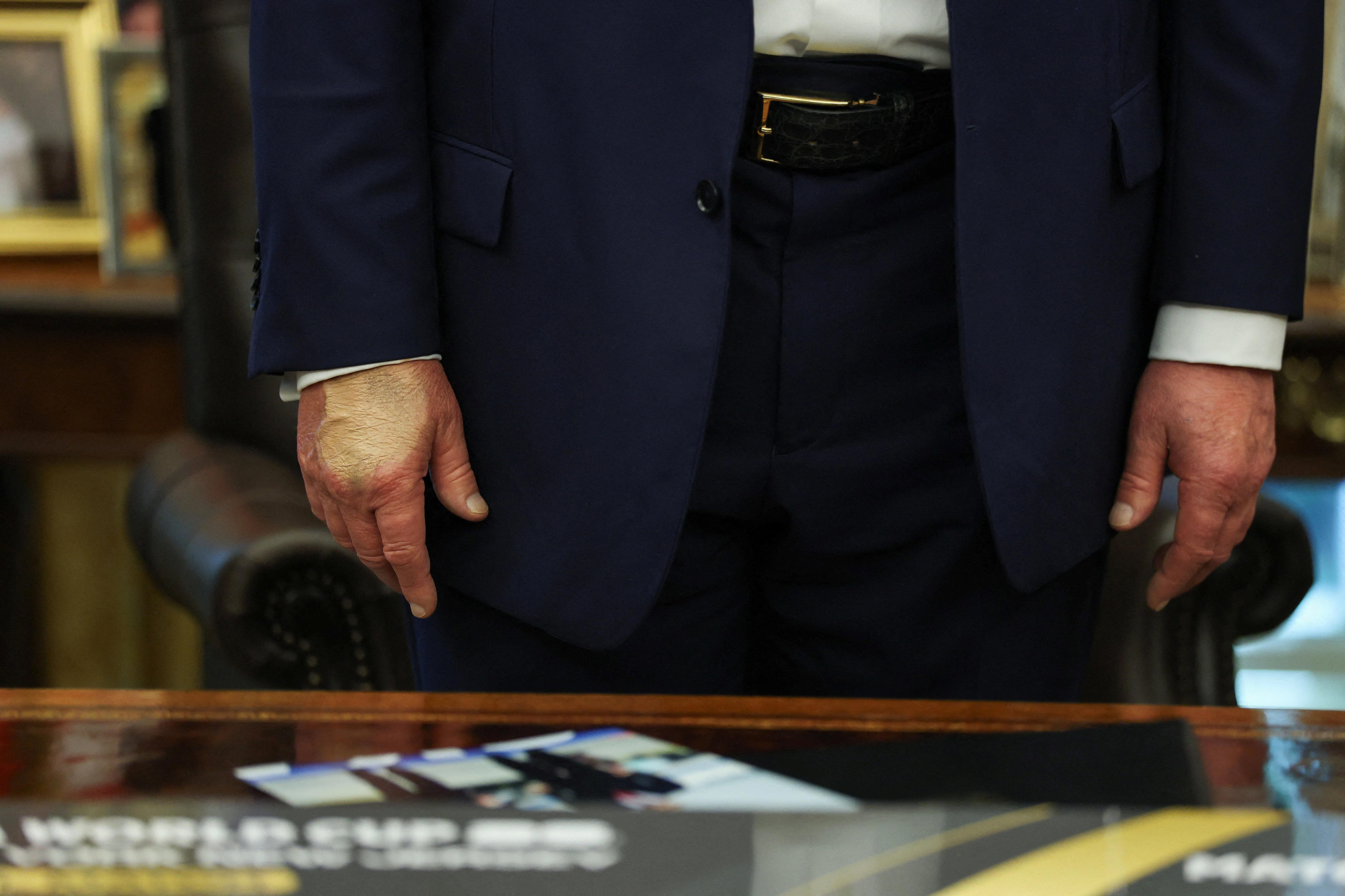 Trump's hand makeup, bruise go viral again. Here's what the White House ...