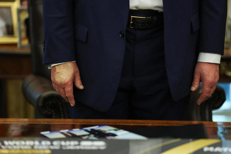 Trump's hand makeup, bruise go viral again. Here's what the White House ...