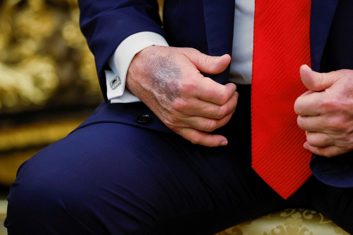 Trump reveals dark bruising on hand as he goes cover-up-free in Oval ...
