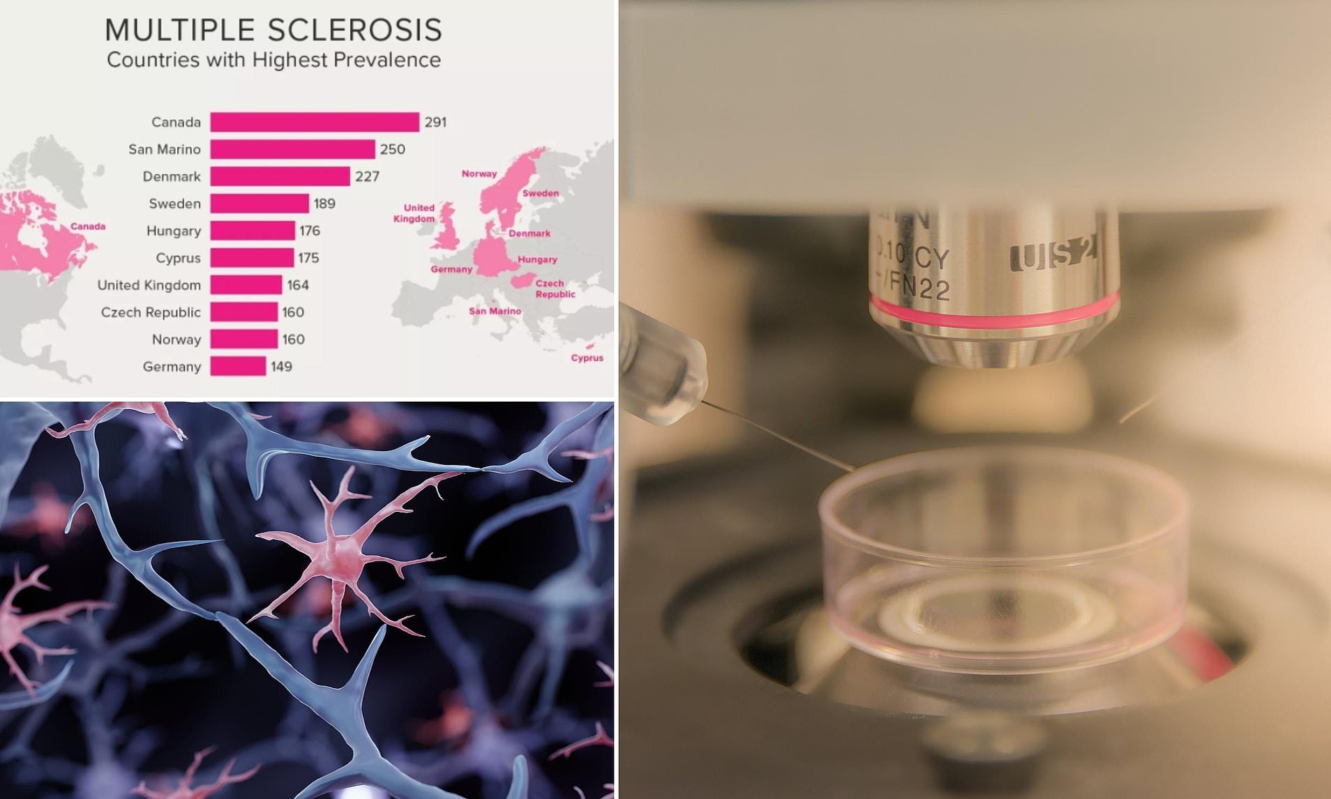 EMB 4PM Breakthrough in fight against nerve disease that's rising in ...