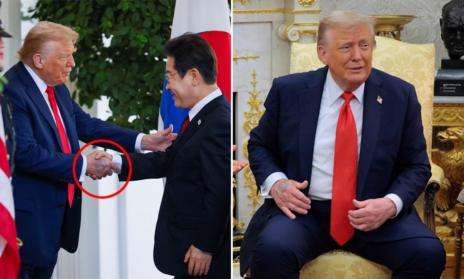 Donald Trump health worries mount as president, 79, spotted with another dark bruise on his hands