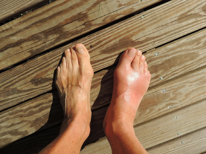 King's disease gout, why male patients are the majority