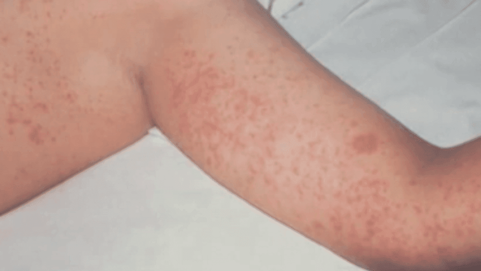 First case of measles reported in Alabama since 2002, vaccination ...
