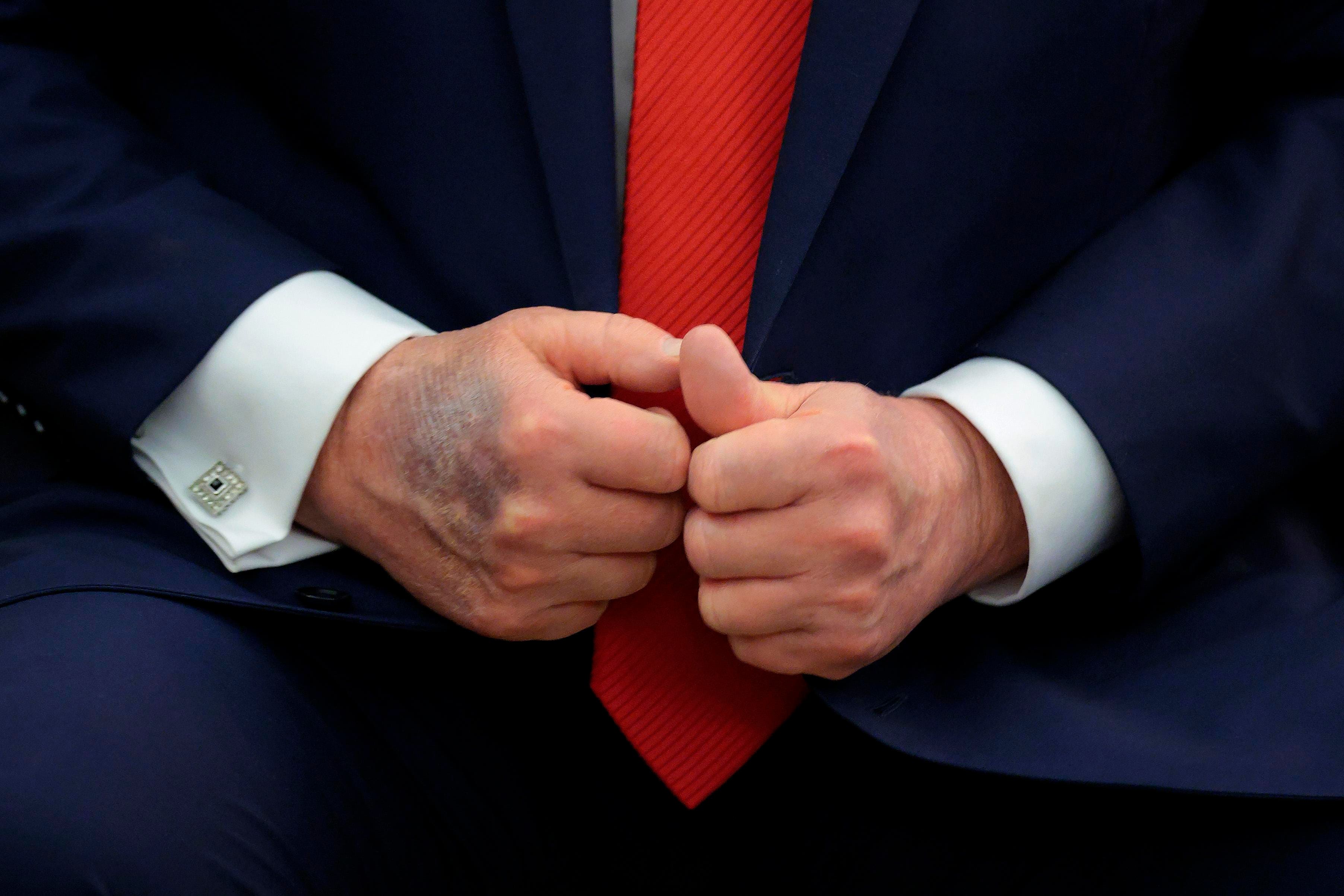 Trump Seen With Bruised Right Hand Again—Here’s Everything We Know ...