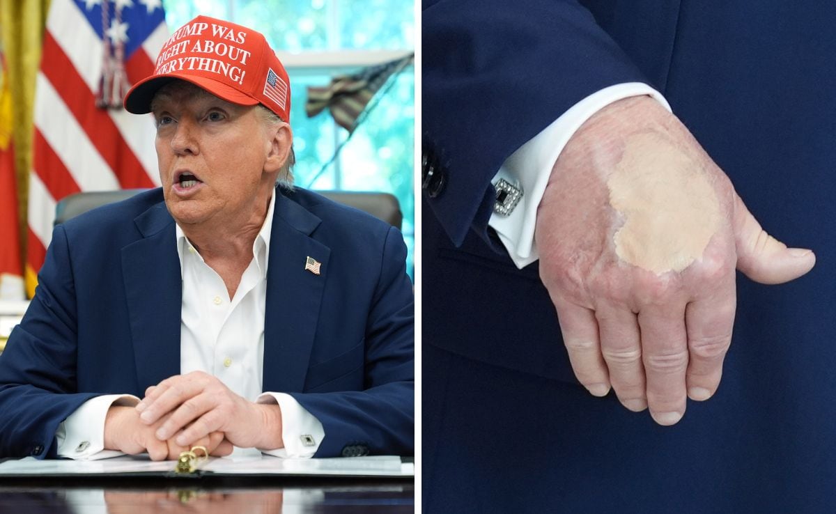 Trump's Hand Bruise, Makeup Is Viral Again. What The White House Said ...