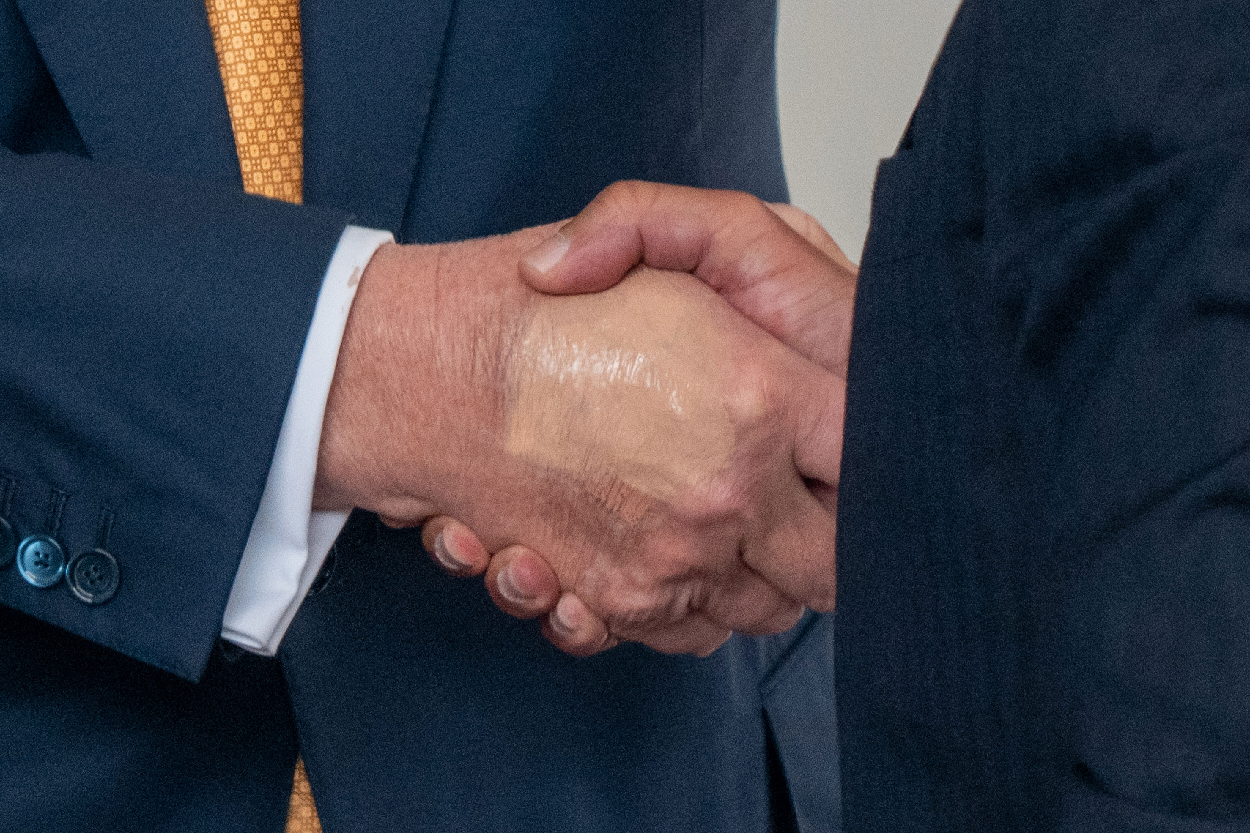 De gehavende handen van Donald Trump onder de loep: "Mensen verdienen ...