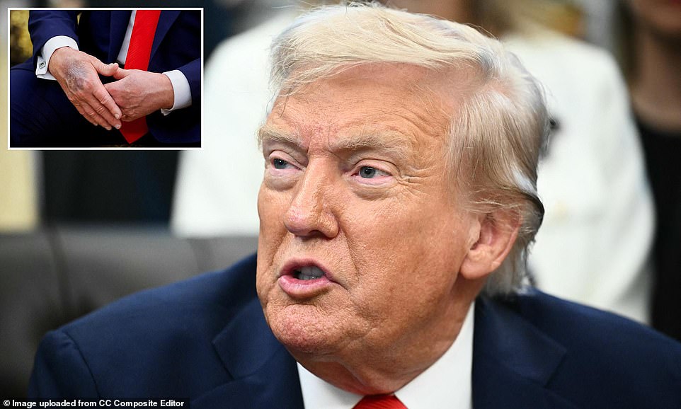 Trump health rumours swirl after fresh hand bruising spotted