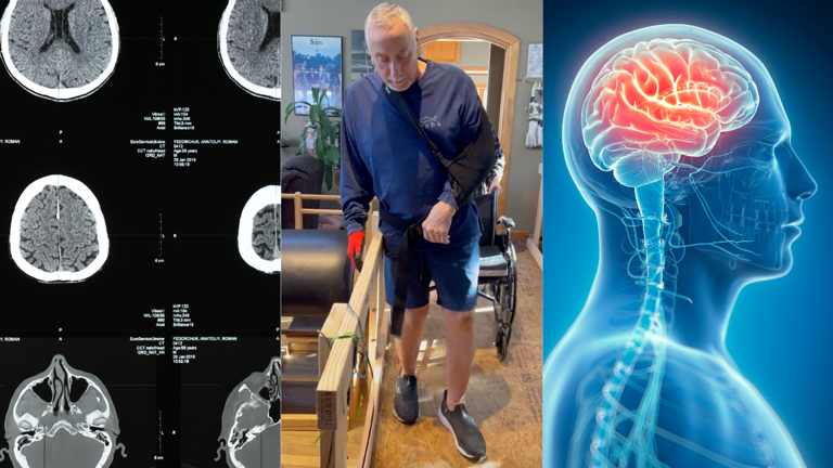 Ohio Man Walks Again After Stroke, Thanks To New Implant Technology