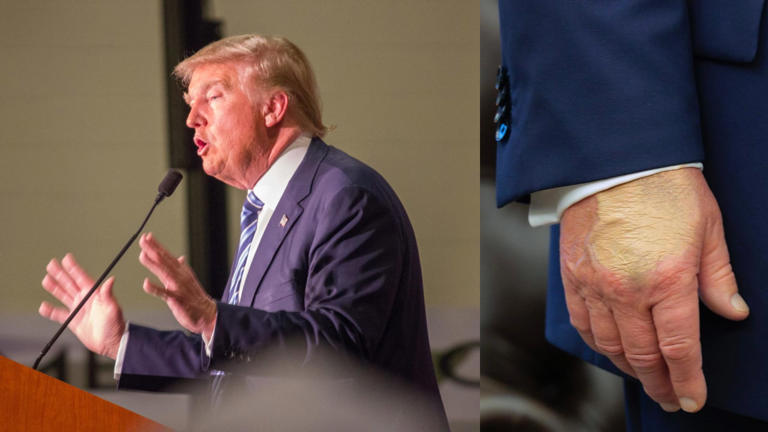 Why Is Trump's Hand Always Bruised? Viral Photos of 'Battered Hands ...