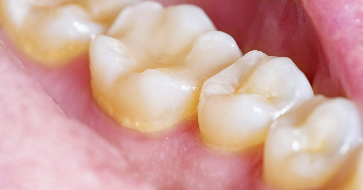 5 Home Remedies for Removing and Preventing Dental Plaque