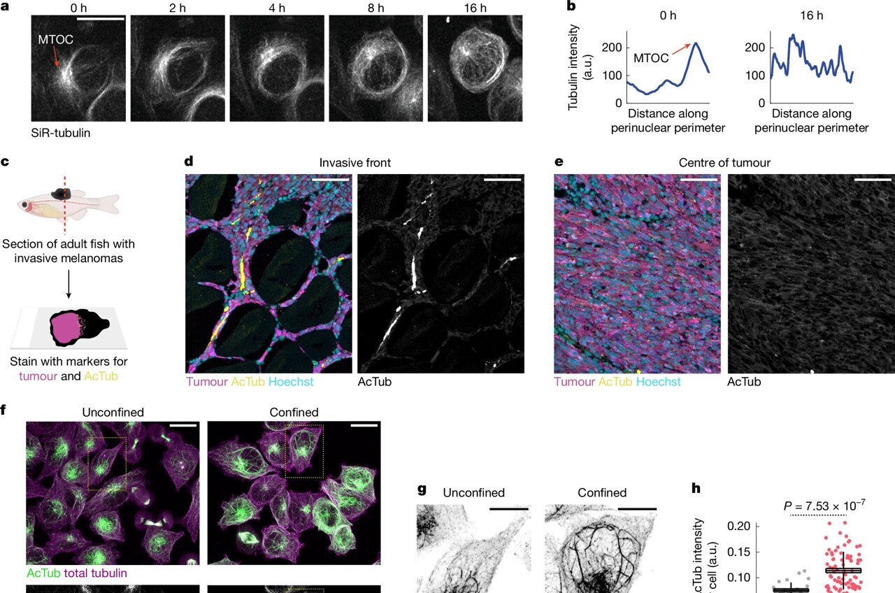 Pressure flips the switch on cancer cells: How confinement drives ...