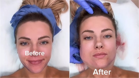 Woman's cosmetic surgery goes terribly wrong after filters distorted ...