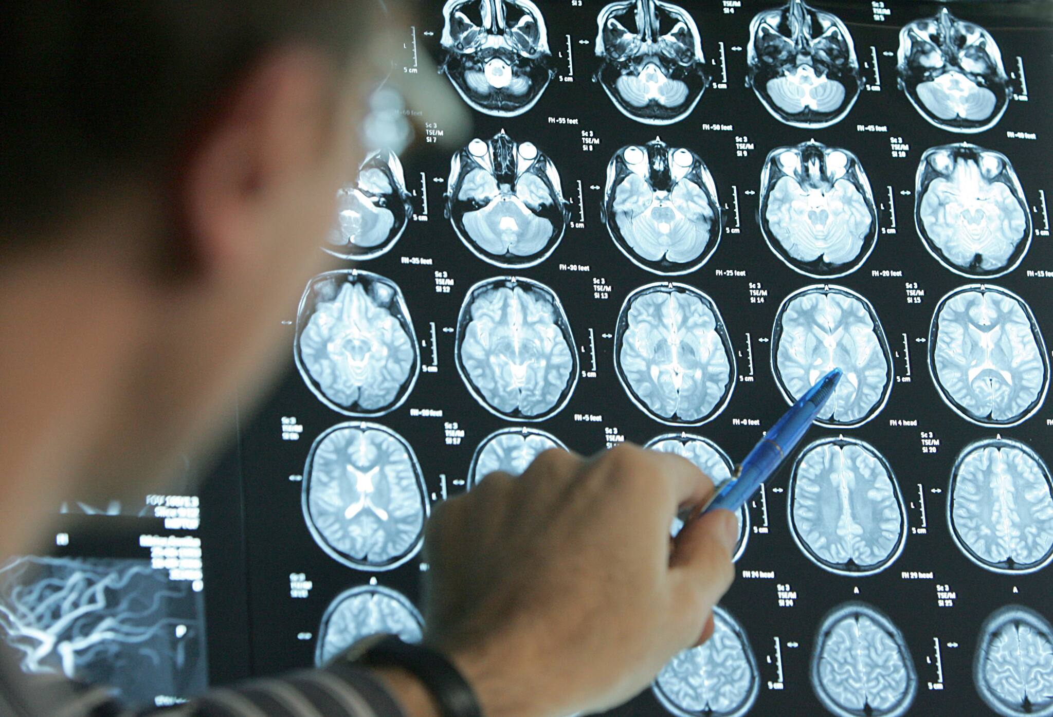 FAST-Test: Schlaganfall erkennen und Symptome sofort deuten