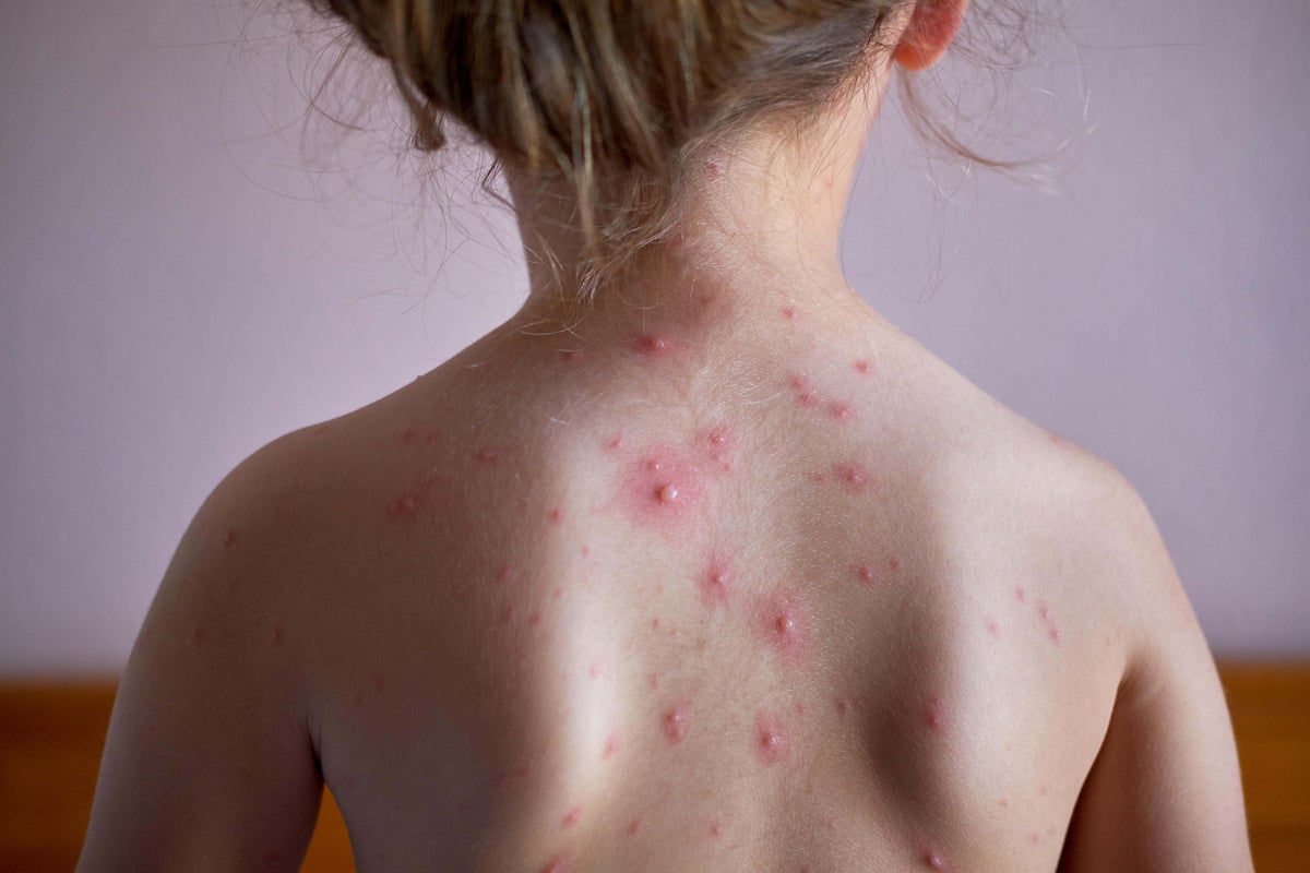 Vaccine for chickenpox to be rolled out on the NHS