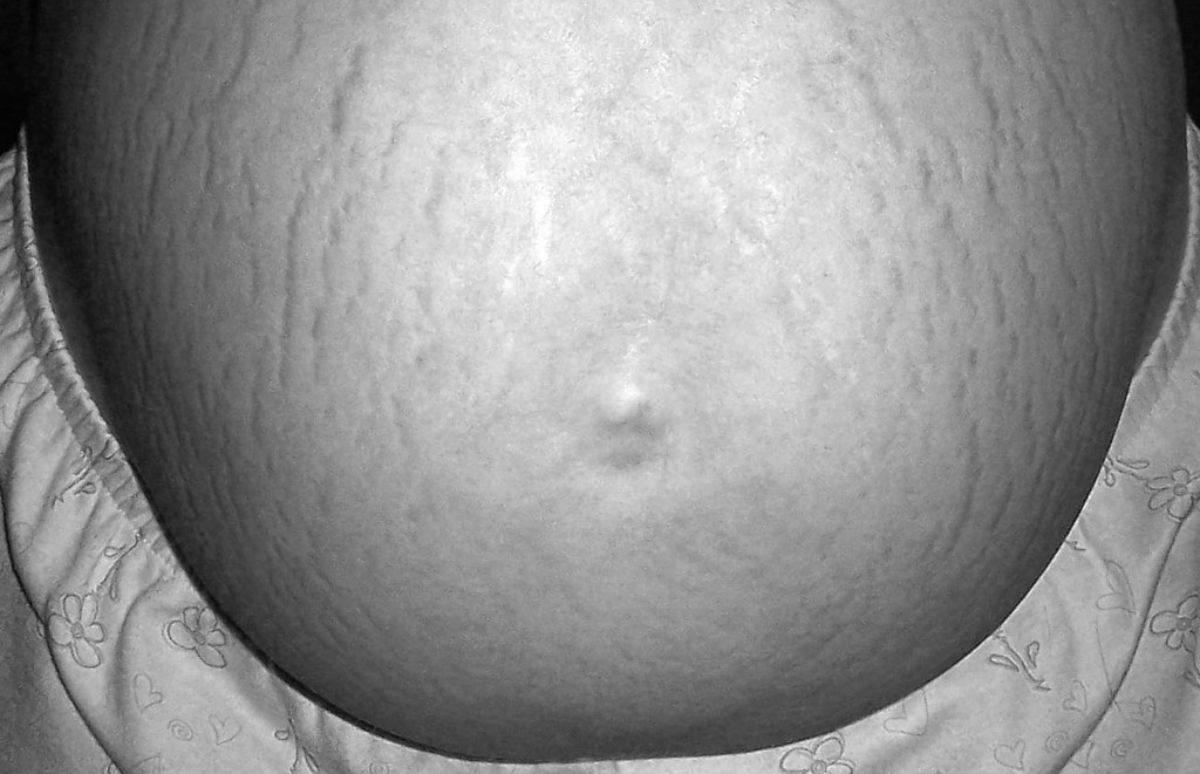 9 Cara Efektif Menghilangkan Stretch Mark di Paha, Betis, dan Area ...