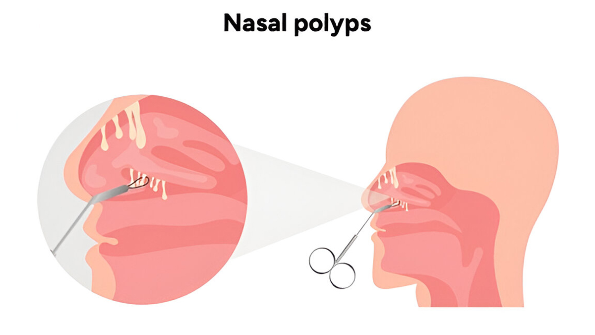Trouble Breathing Through Your Nose? 10 Things To Know About Nasal Polyps