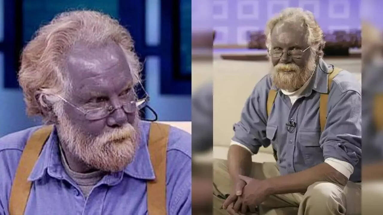 What is Smurf syndrome that turns skin blue-grey: Know its symptoms ...