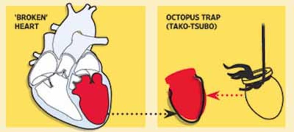 Study: How to protect against 'broken heart syndrome'