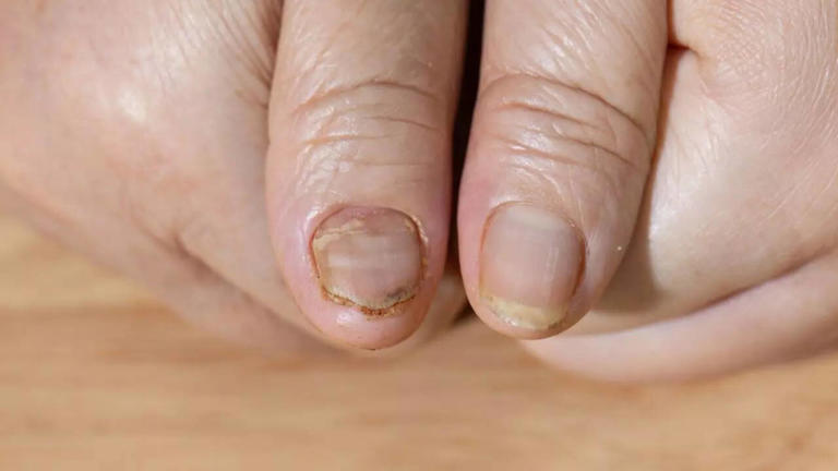 Brittle nails could be a sign of serious health problems: Causes and ...
