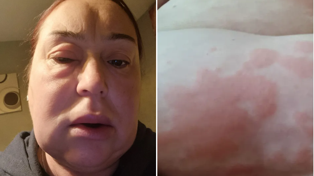 ‘NHS hernia mesh implant left me in chronic pain and unable to work’