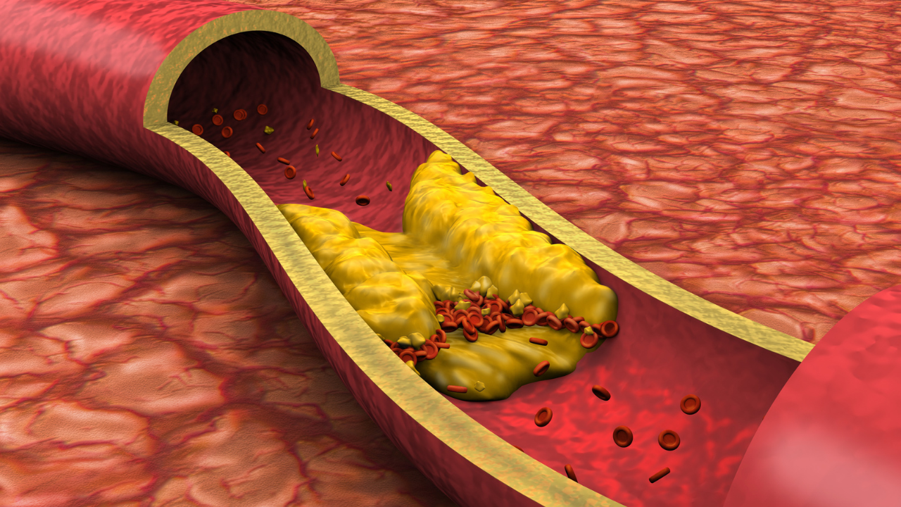Blood Cholesterol vs Brain Cholesterol: What is the difference?