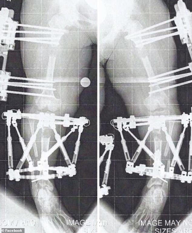 Teen who had controversial surgery to grow 13 inches reveals what she ...