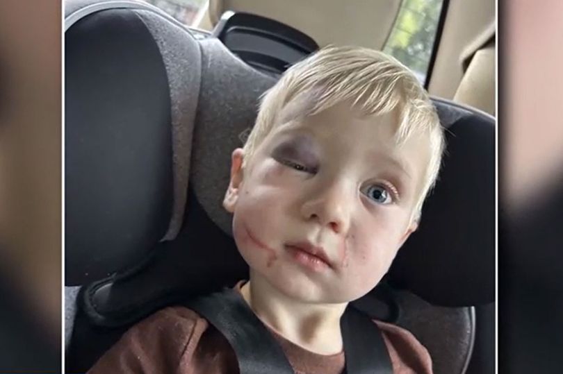 Chilling reason behind boy's bruises as he's left battered by ...