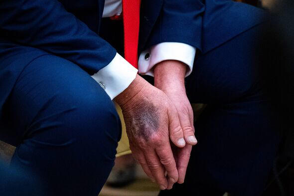 Trump's hand 'bruise' could indicate serious condition - signs to watch for