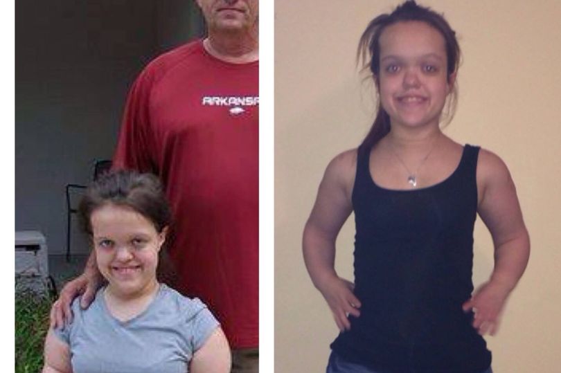 Teen's $2M surgery to grow 13 inches reveals what she looks like 15 ...