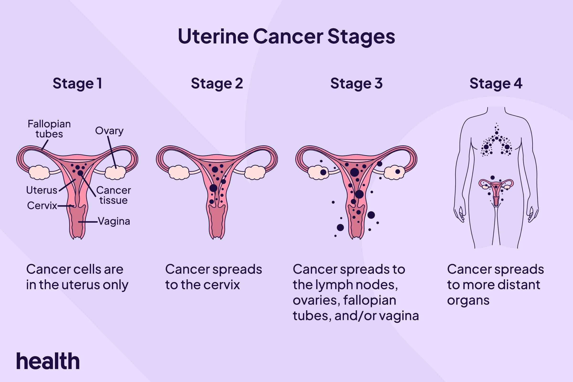 The 4 stages of uterine cancer—and what each one means