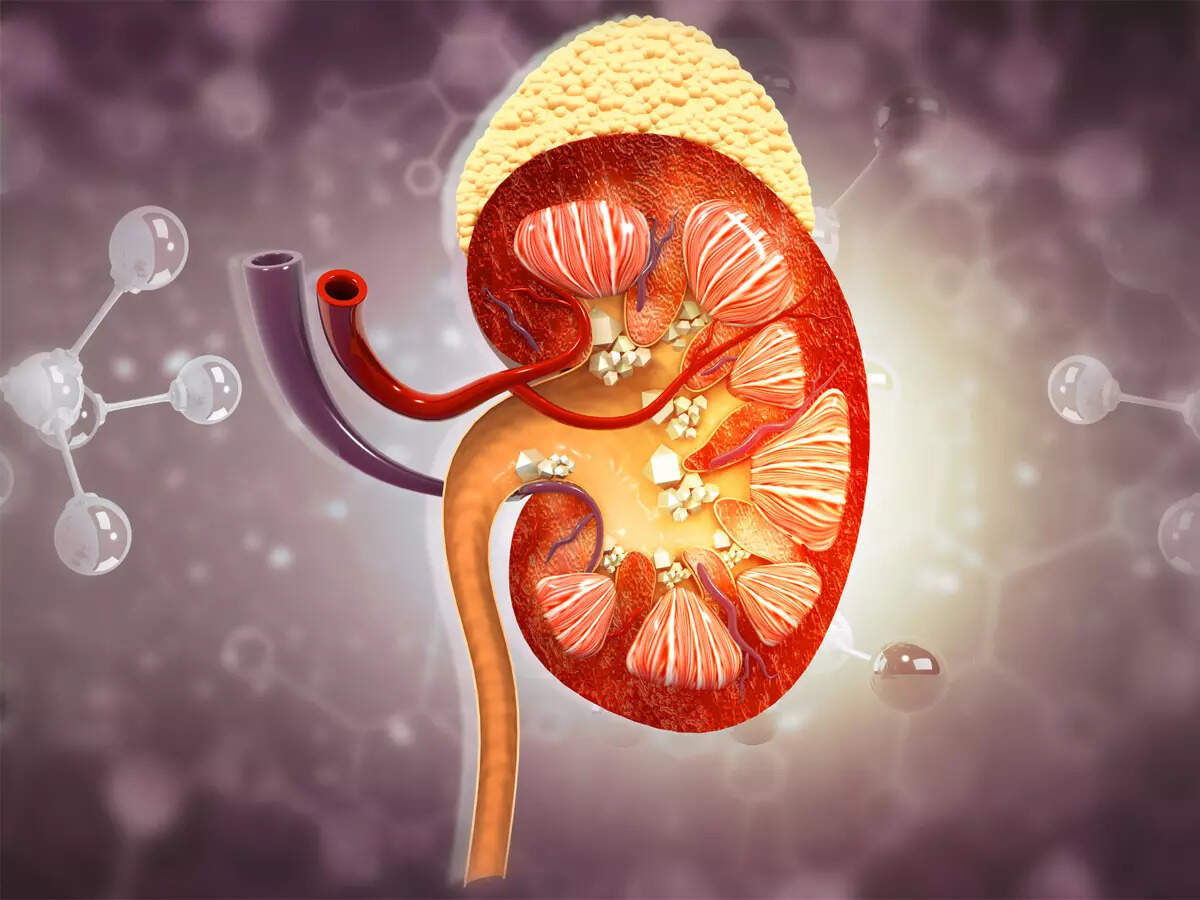 Kidney stone prevention: 6 foods to avoid & what to eat instead