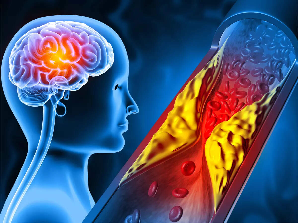 Blood vs brain cholesterol: What's good, what's risky, and why age matters