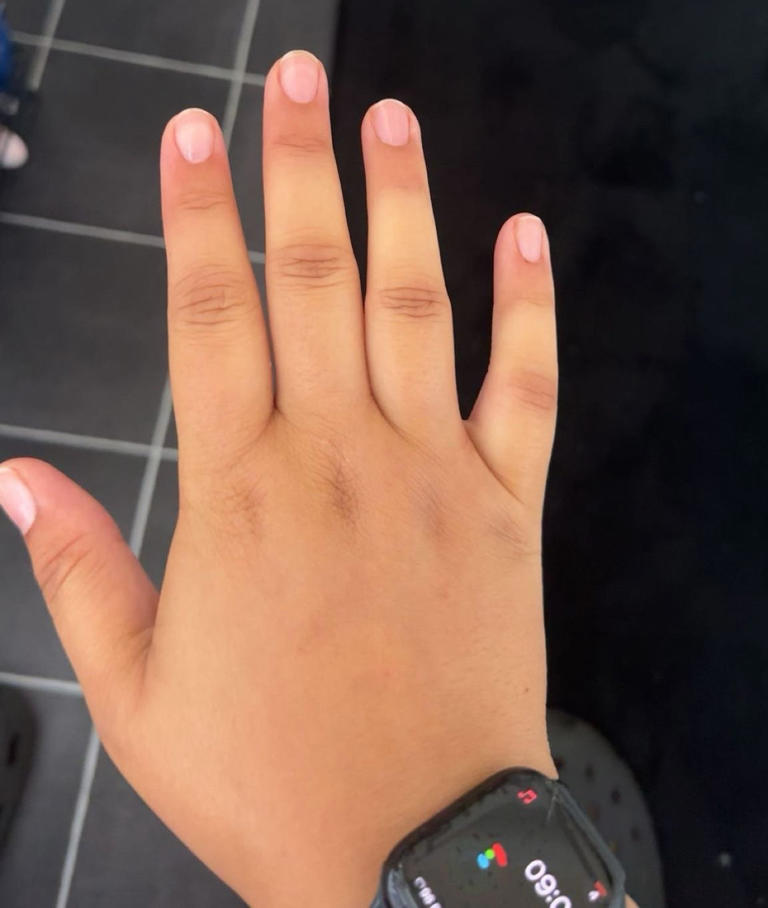 ‘Healthy’ woman diagnosed with rare autoimmune disorder after rash