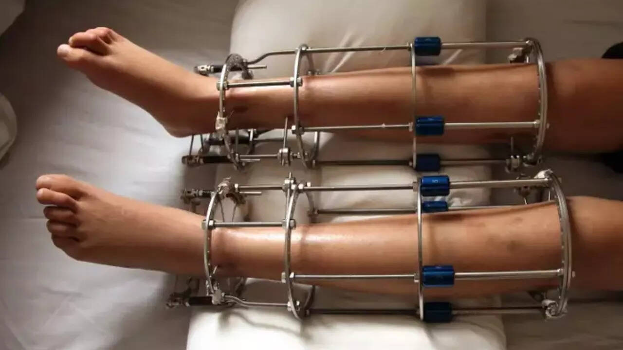 Break legs to get taller? Inside the dangerous, agonizing surgery to ...