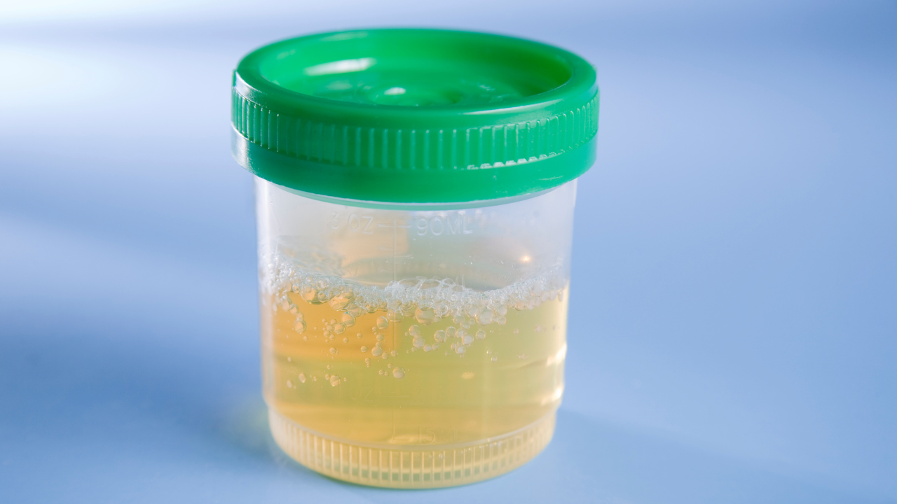From foamy urine to fatigue: 6 signs of kidney damage that often go ...