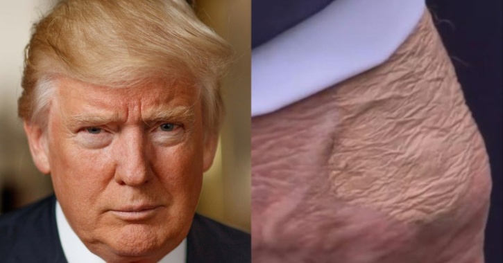 What mysterious pill did Donald Trump take at US Open final? Experts ...