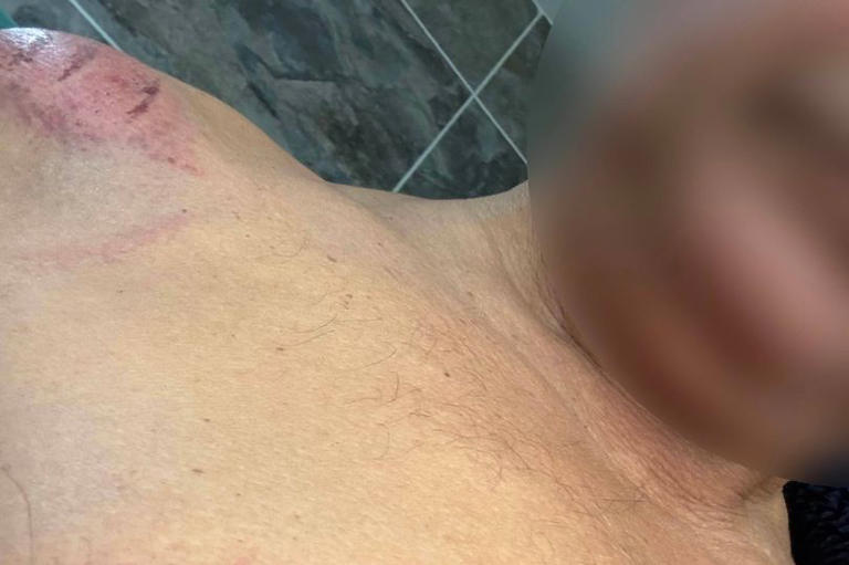 Man left with 'claw' injuries convinced he was attacked by leopard in ...