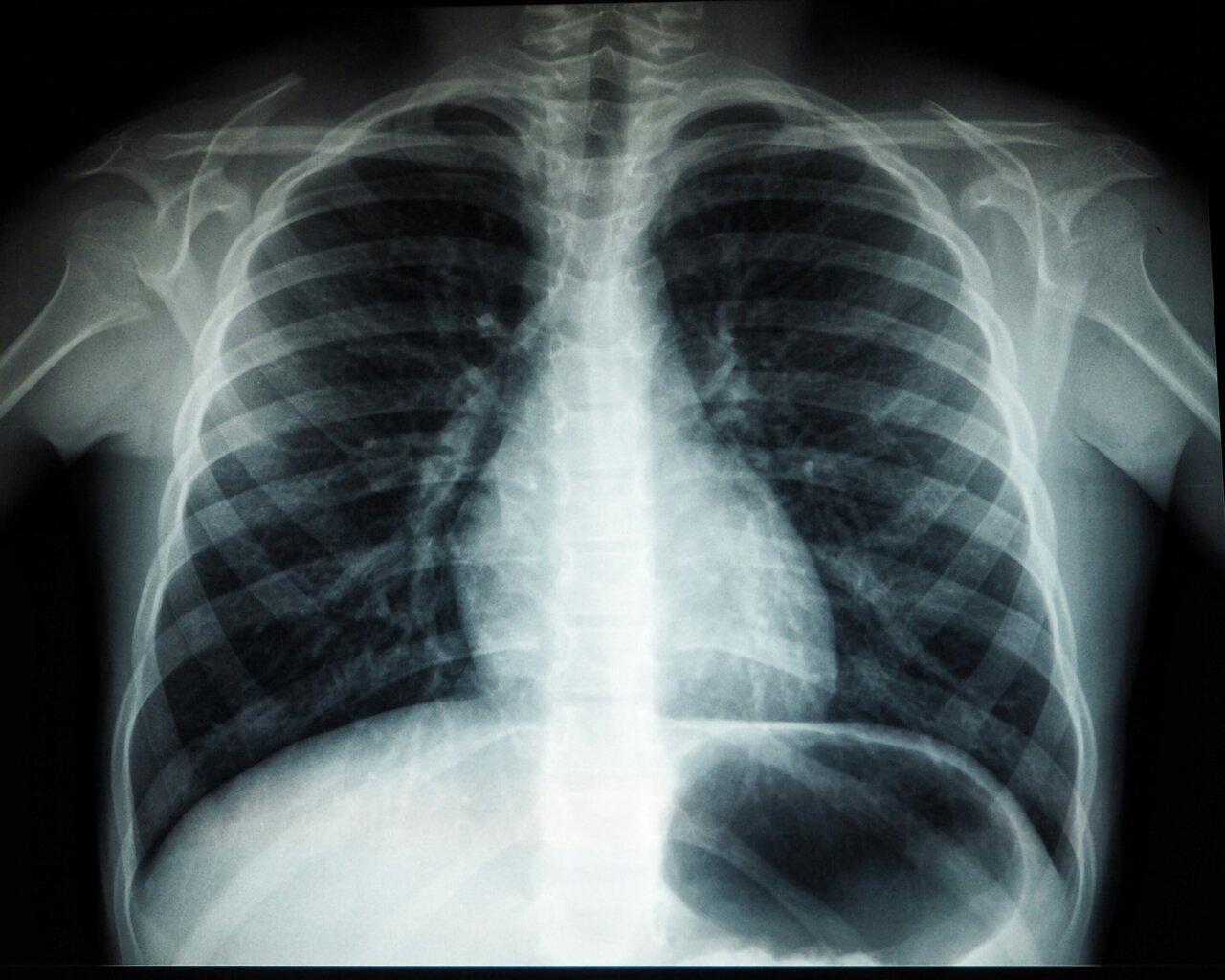 Light switch wakes lung cancer cells up from a protective dormant state