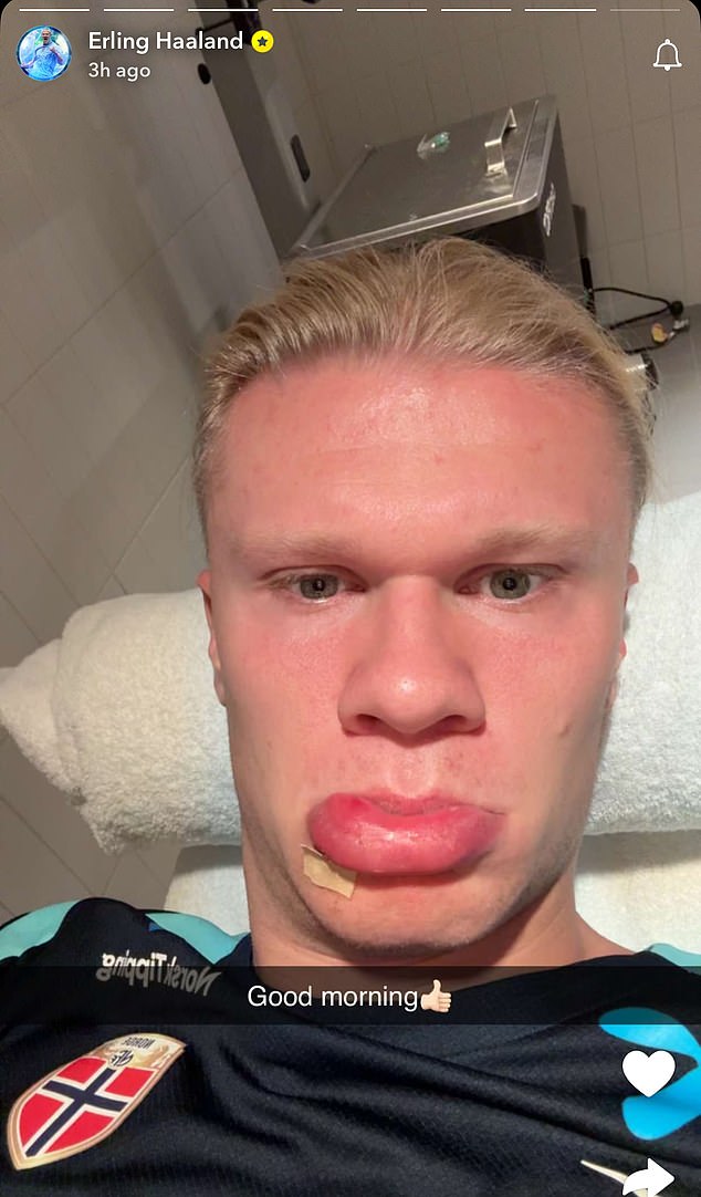 Erling Haaland pokes fun at gory injury as he shares new picture after ...