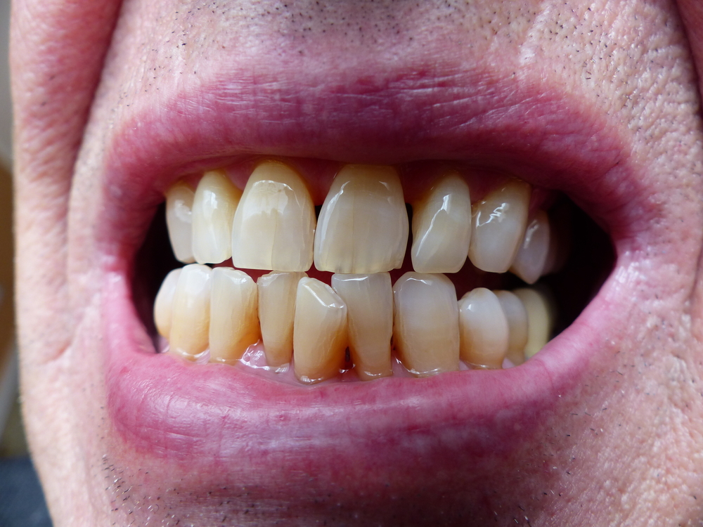 Experts warn: These everyday foods could be turning your teeth yellow