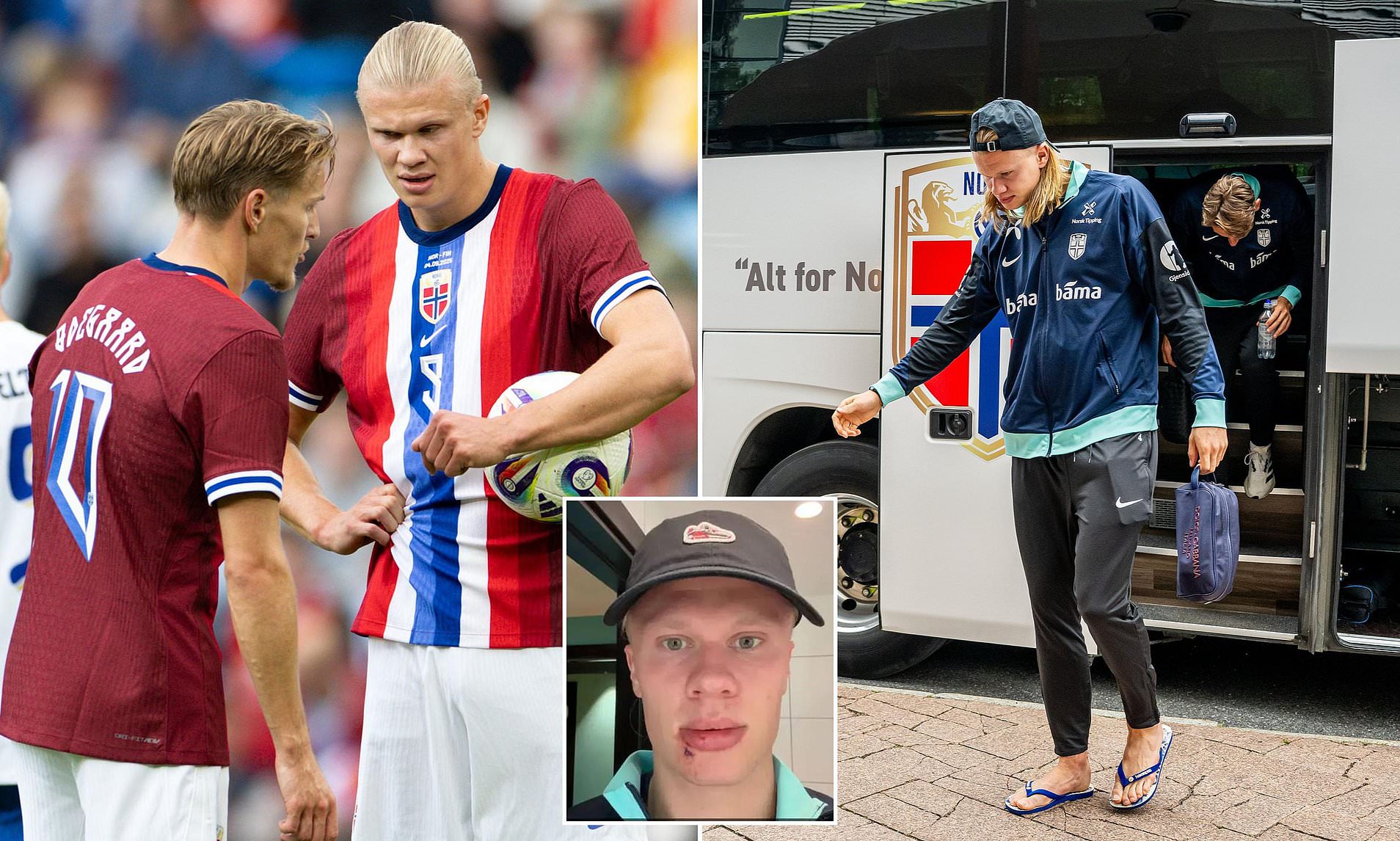 Erling Haaland pokes fun at gory injury as he shares new picture after ...