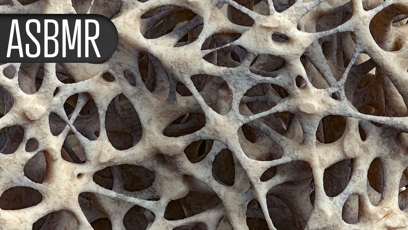 Drugs Boosts Bone Mineral Density in Premenopausal Osteoporosis