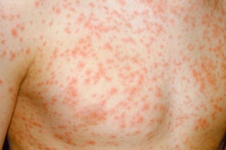 New measles alert as cases hit 13 year high - Salford remains one of ...