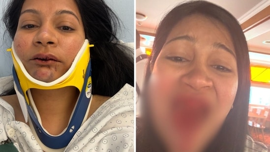 ‘12 damaged teeth, cut on chin’: Indian-origin couple claims brutal ...