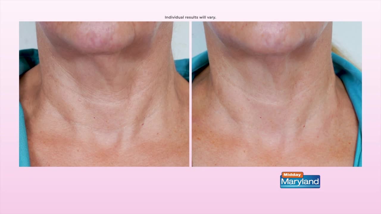 Visibly transform delicate neck skin with Dekliderm